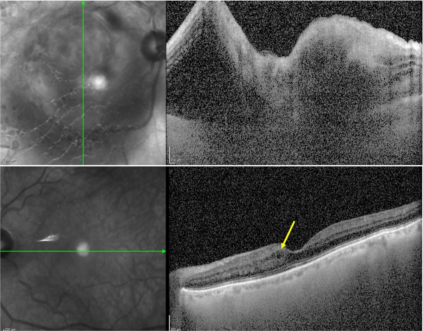 Case: A relentless retinitis (Case Club 2-3; 30 Mar, 2023) – EURETINA