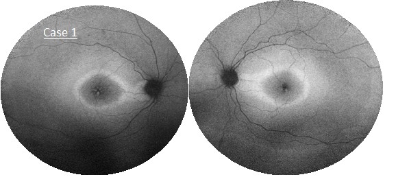 Case: Unusual phenotype/genotype correlation in an inherited retinal ...
