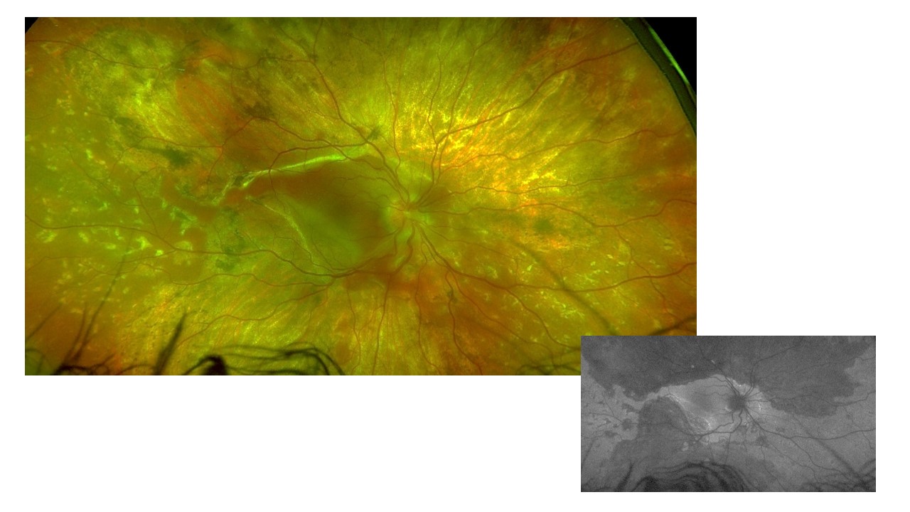 Case: A mysterious bilateral stromal choroiditis in a young male ...