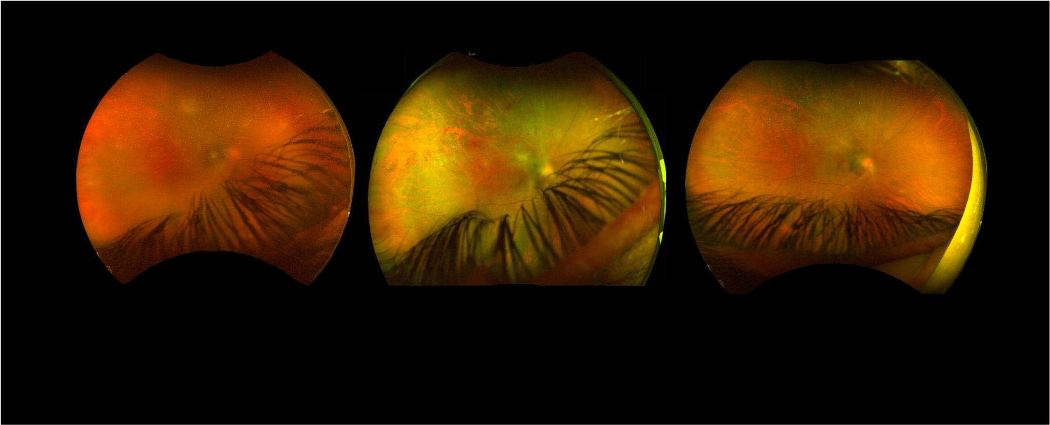 Case: Those retinal infiltrates… what could they be? (Case Club 1-8; 29 ...