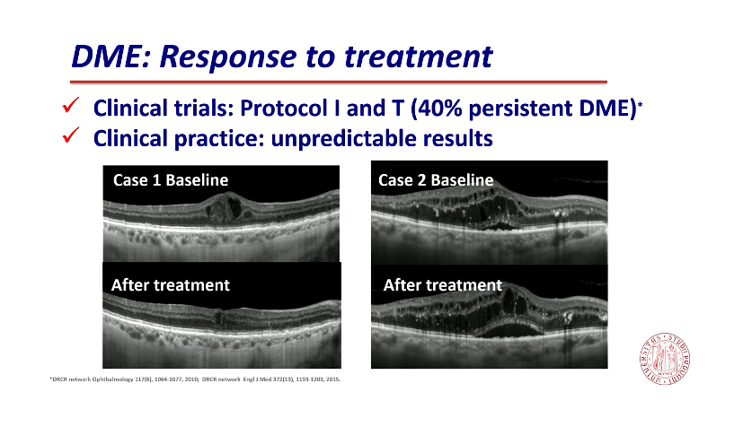 Identifying biomarkers to guide DME treatment – EURETINA