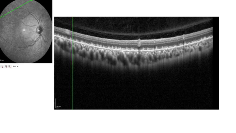 Case: What the fleck is happening! (Case Club 1-3; 20 Jan, 2022) – EURETINA